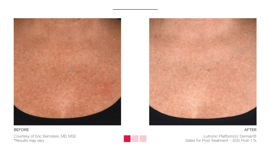 Derma V Pigmentation Treatment in SoHo | Weiser Skin MD